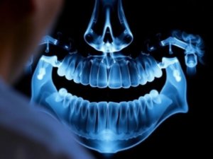 Dental X-rays: Understanding Their Safety and Importance in Care